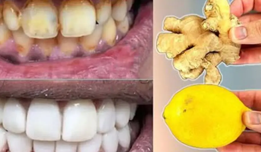 Instant Teeth Whitening: Ginger & Lemon Remedy for a Brighter Smile in ...