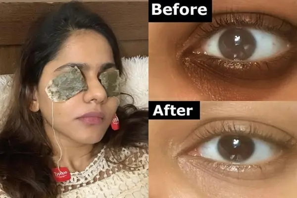 Tea bags for eyes: Follow these 8 tips to reduce puffiness and dark circles