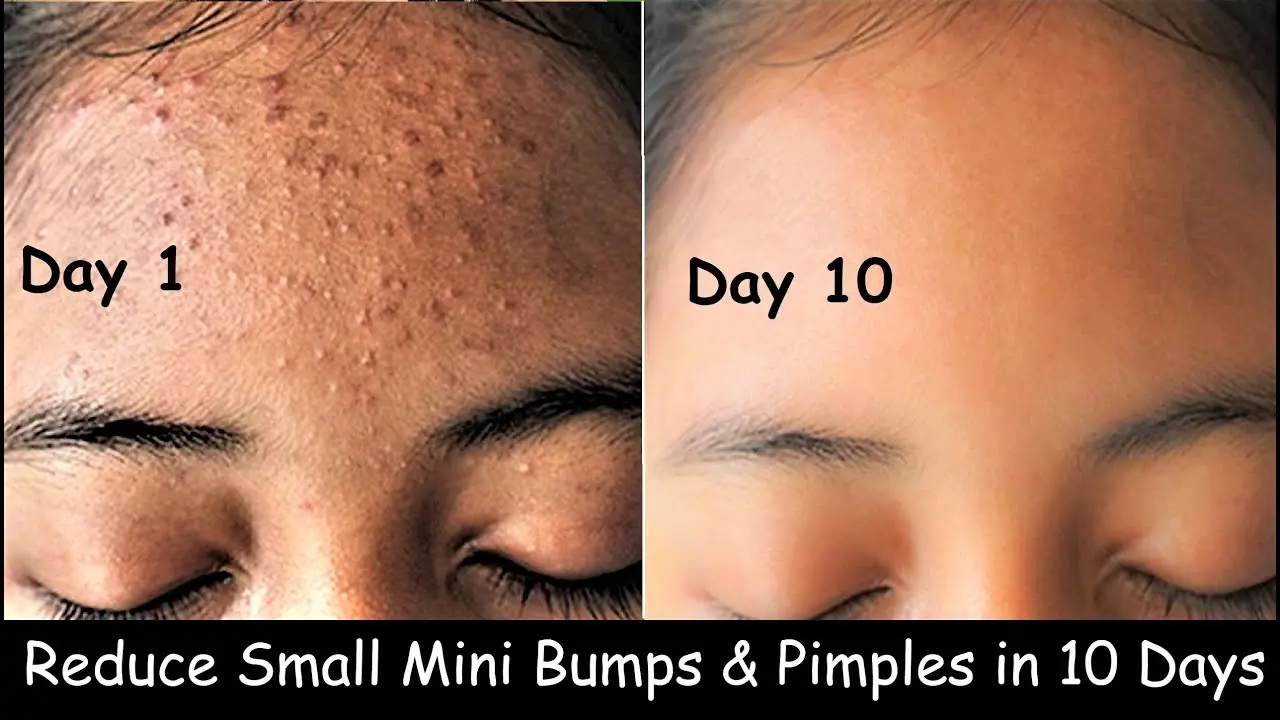 Get rid of tuny bumps on face - Small head bumps & pimples | Fungal ...